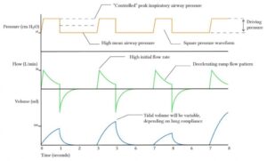 Pressure vs Volume Controlled Ventilation | Critical Care Insights